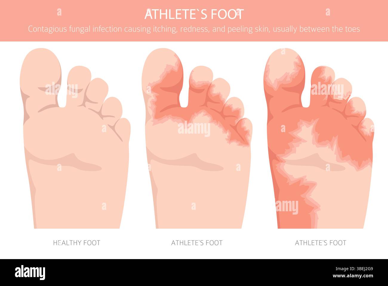 Athlete`s foot. Tinea pedis skin condition. Skin diseases. Medical infographic design. Vector ...